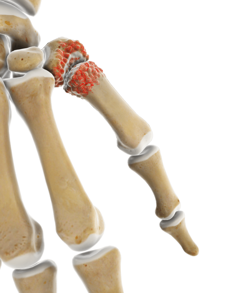 Surgical Hand & Wrist Treatments - CRMC